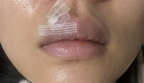 입술 찢어짐 응급실 봉합 성형외과 교상 흉터 교정술 레이저 네이버 블로그