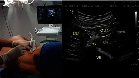 A Position And Orientation Of The Curvilinear Ultrasound Transducer