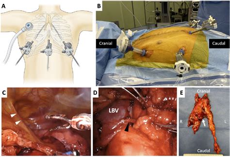 Figure 1 From Robotic Subxiphoid Optical Thymectomy Semantic Scholar