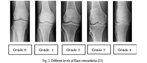 Knee Osteoarthritis Detection And Severity Prediction Using Convolutional Neural Network