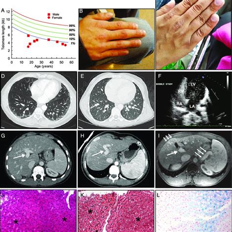 Characteristics Of Patients With Short Telomere Syndromes Download