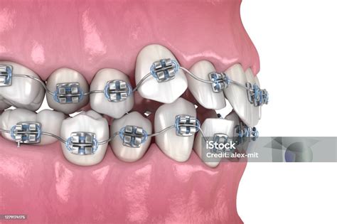 비정상적인 치아 위치 및 금속 중괄호 트레타먼트와 보정 의학적으로 정확한 치과 3d 일러스트레이션 0명에 대한 스톡 사진 및 기타 이미지 Istock