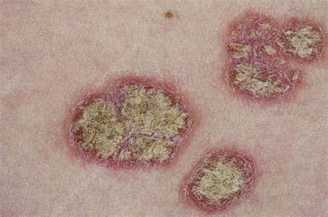 Plaque Psoriasis On The Skin Stock Image C0156016 Science Photo Library