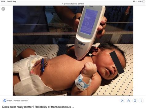 Neonatal Hyperbilirubinemia Flashcards Quizlet