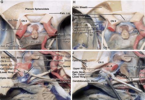 Stepwise Dissection Of The Roof Of The Cavernous Sinus Neuroanatomy
