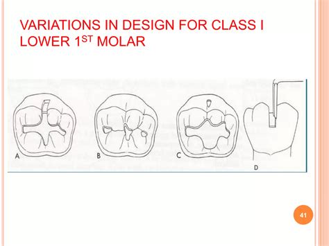 Class I Cavity Preparation Pptx