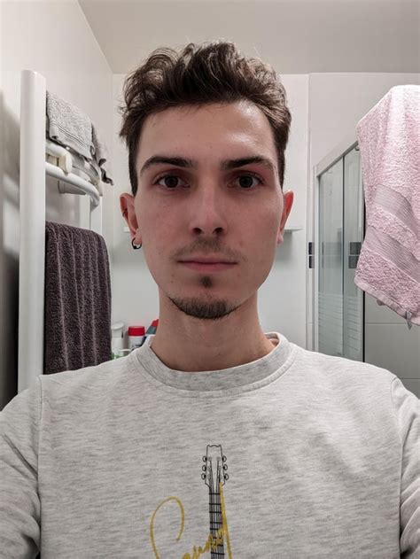 Ongoing Case Unilateral Condylar Hyperplasia Asymmetry R Jawsurgery