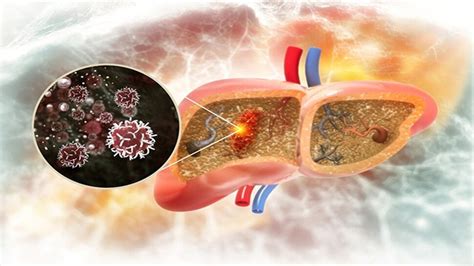 Causes And Precautions For Liver Cancer ಎಣ್ಣೆ ಹೊಡೆದು ಸಿಗರೇಟ್‌ ಸೇದಿದರೆ