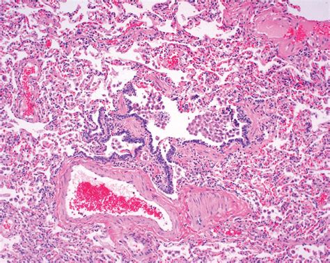 Chronic Diffuse Lung Diseases Clinical Tree