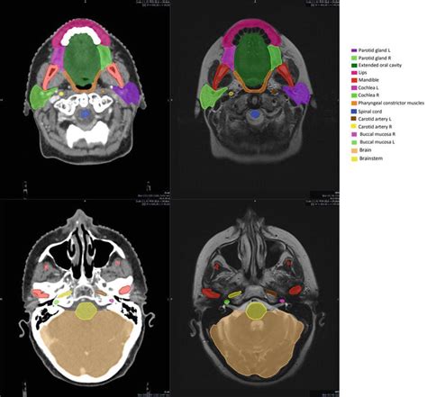 Treatment Of Head And Neck Cancers Using Radiotherapy Intechopen