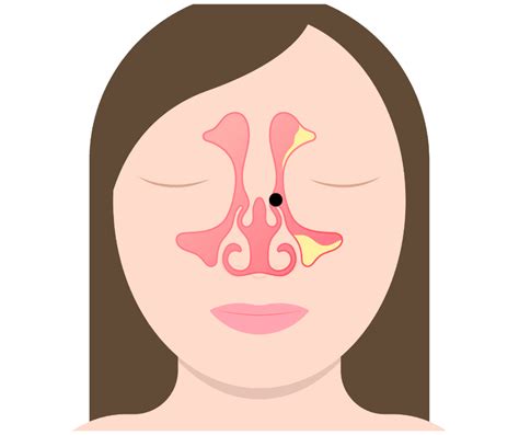 Sinusitis Causes Symptoms And Effective Treatments Dr Salmas Ent