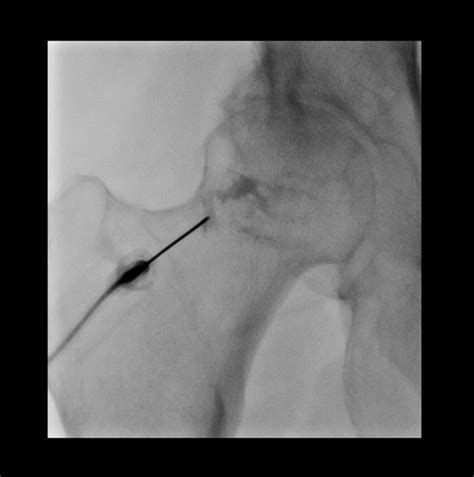 Radiopaedia Case Synovitis On Hip Arthrogram Injection Fluoroscopic