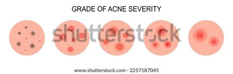 Grade Acne Severity Medical Diagram Different Stock Vector Royalty Free 2257187045 Shutterstock