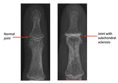 Osteoarthritis On An X Ray Fife Virtual Hand Clinic