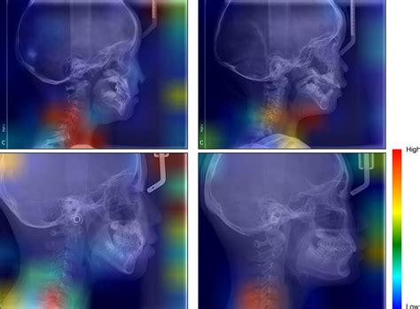 Age And Sex Estimation In Cephalometric Radiographs Based On Multitask