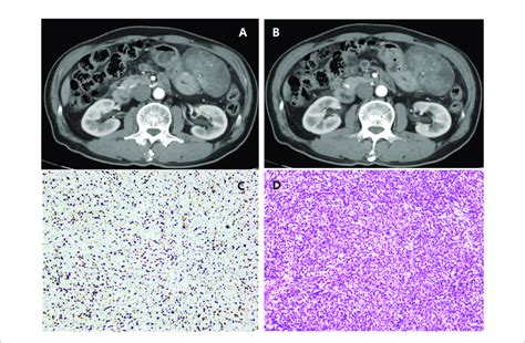 A Patient With Intestinal Gastrointestinal Stromal Tumor Gist Download Scientific Diagram