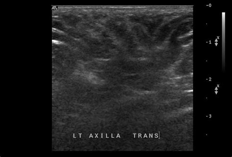 Accessory Breast Tissue Pacs