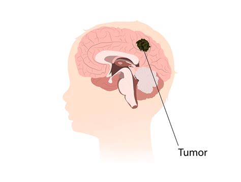 Astrocitomas Dr Vidaurreta