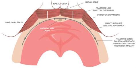 Multidimensional Scheme Of The Hybrid Splitting Expansion And Palatal