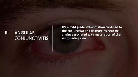 Conjunctivitis Pptx
