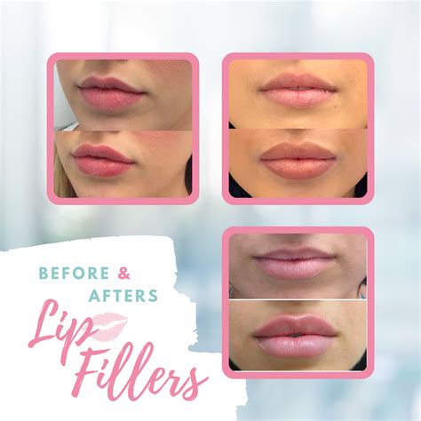 Perfect Lip Shapes