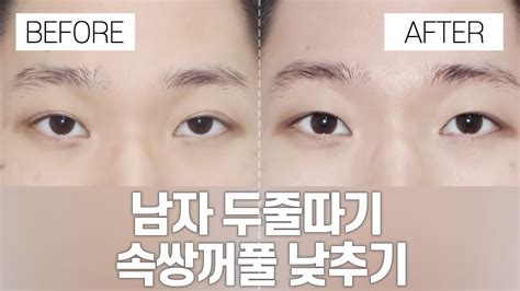 눈 성형 전후 강남서연 남자 두줄따기 속쌍꺼풀 낮추기 4개월 전후 Youtube
