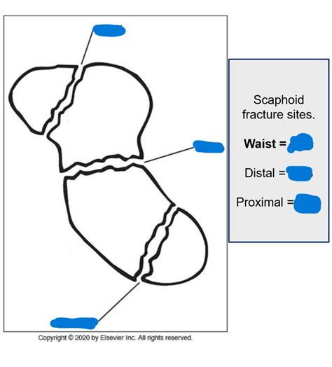 Scaphoid Fractures Label Diagram Quizlet