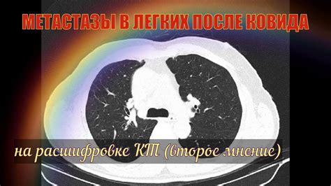 ОЧАГИ в легких ПОСЛЕ КОВИДА метастазы в легких на КТ расшифровке ВТОРОЕ МНЕНИЕ Youtube