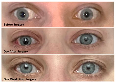 Surgery Results Absolutely Thrilled R Strabismus