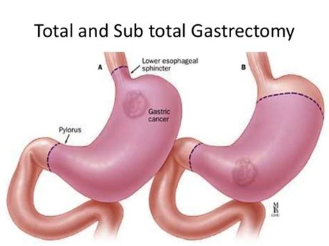Total Gastrectomy For Stomach Cancer
