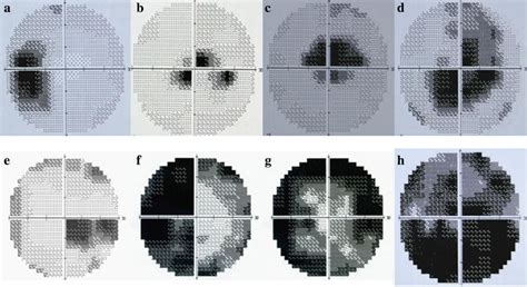Visual Field Defects Found In Patients With Lhon From The First To The Download Scientific