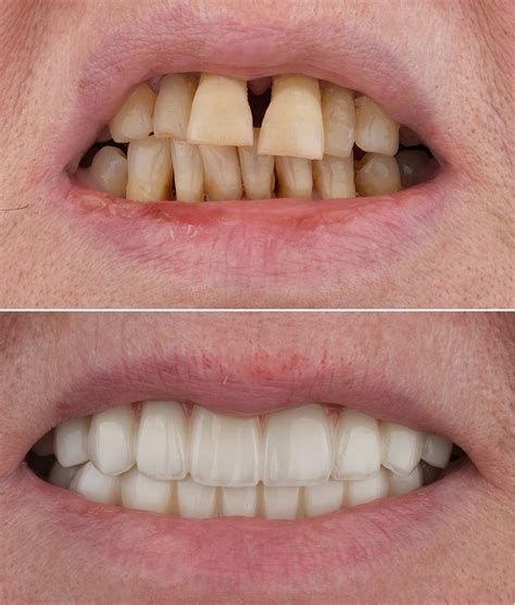 Nanofill Composite Bonding Cost Compare And Procedures