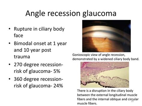 Secondary Glaucoma Finalpptx Eye And Vision Conditions Diseases