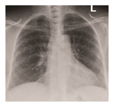 Chest Radiograph Demonstrating Diffuse Micronodular Densities Download Scientific Diagram