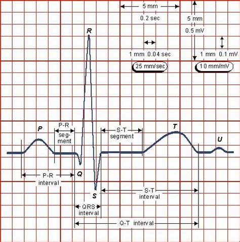 Long QT Syndrome Causes Mechanism Symptoms Treatment