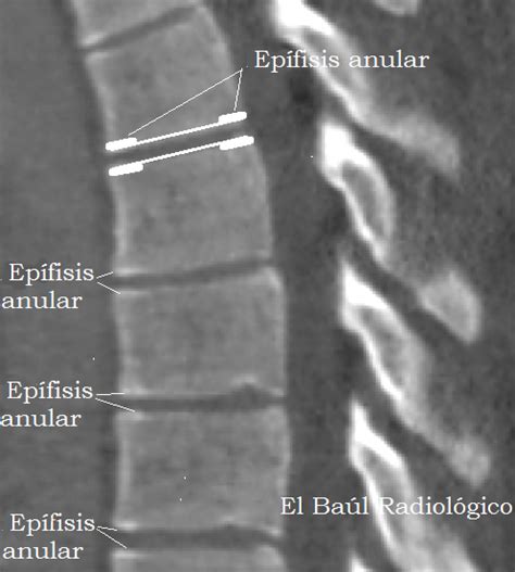 El Baúl Radiológico Enfermedad De Scheuermann Dorsalgia Juvenil