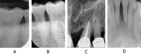 Periodontal Disease Stages