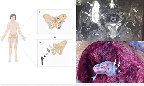 Reconstruction Of Hemipelvectomy I Ii A The Right Pelvis Download Scientific Diagram