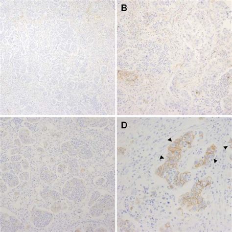 Colonoscopic Findings And Pathological Features Of Invasive Download Scientific Diagram