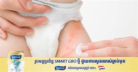 កូនរោលខោទឹកនោម ធ្វើយ៉ាងណាឆាប់បាត់រោល មាតា