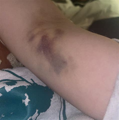 Bruising After Blood Test Rmedical