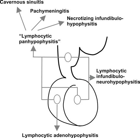 A Hypothetical Schema Presenting Three Types Of Lymphocytic Hypophysitis Lymphocytic
