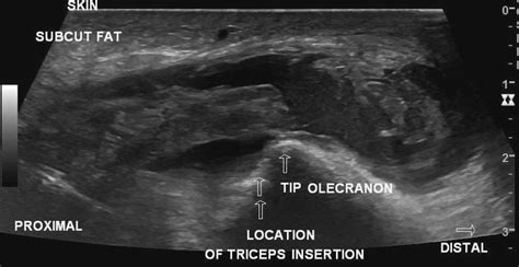 Triceps Anatomy Mri Lateral Head Of Triceps Brachii Muscle Caput