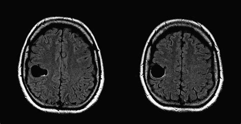 Flair Axial Mr Images Show Abnormal Dilation Of A Virchow Robin Space
