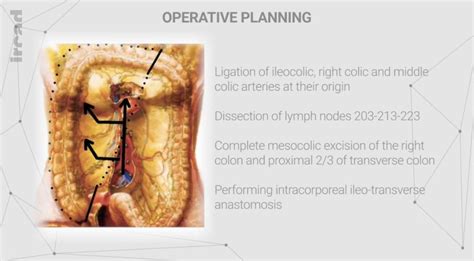 Devendra Singh On Linkedin Laparoscopic Extended Right Hemicolectomy With D3 Lymphadenectomy A…