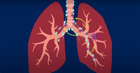 Lung Nodules Pulmonary Nodules American Lung Association