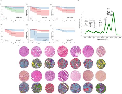 Prediction Of Post Treatment Recurrence In Early Stage Breast Cancer