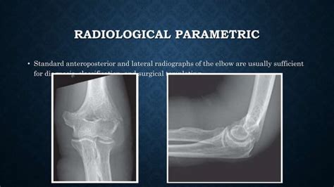 Upper Extremity Fracture Principles Ppt