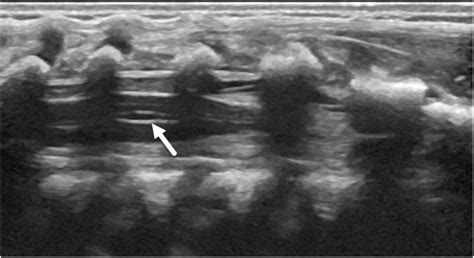 Ventriculus Terminalis Fifth Ventricle In A 25 Day Old Girl A Normal