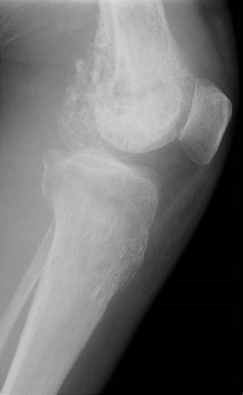 Exported Epithelioid Angiosarcoma Of The Leg